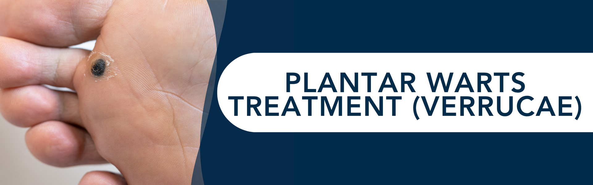 Plantar Warts Treatment (Verrucae) | FootMotion Foot Care